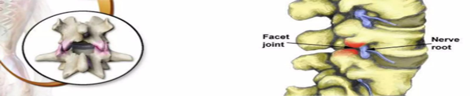 Facet Arthritis - Dr. Mahmood Ahmad