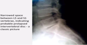 PLID (Prolapsed Lumbar Intervertebral disc) - Dr. Mahmood