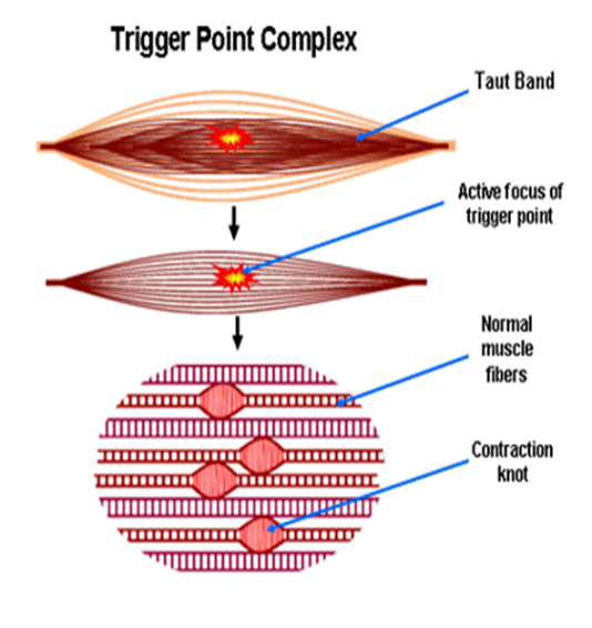 TRIGGER POINTS - Dr. Mahmood Ahmad