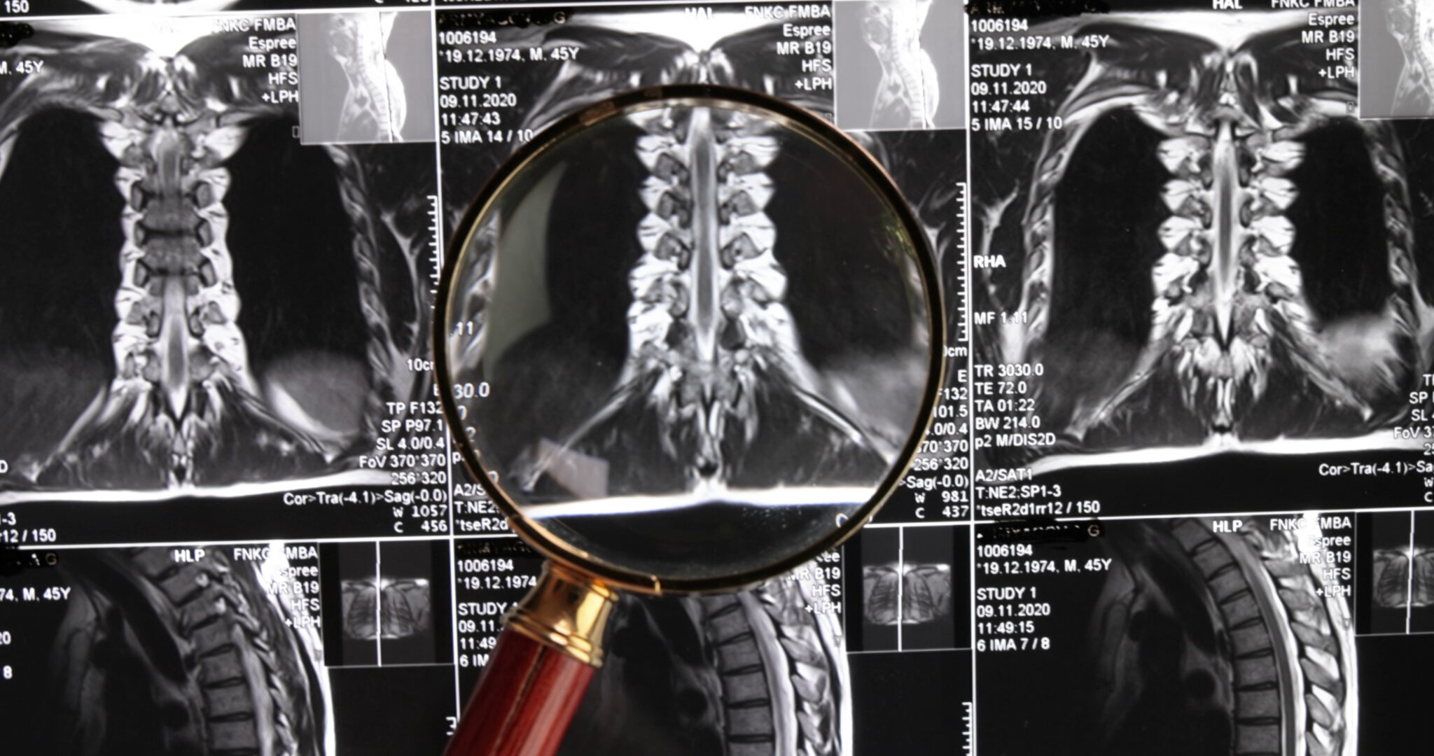 4 Types of Disc Herniation - Dr. Mahmood Ahmad