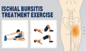 Ischial Bursitis Treatment Exercises for Pain Relief - Dr. Mahmood Ahmad